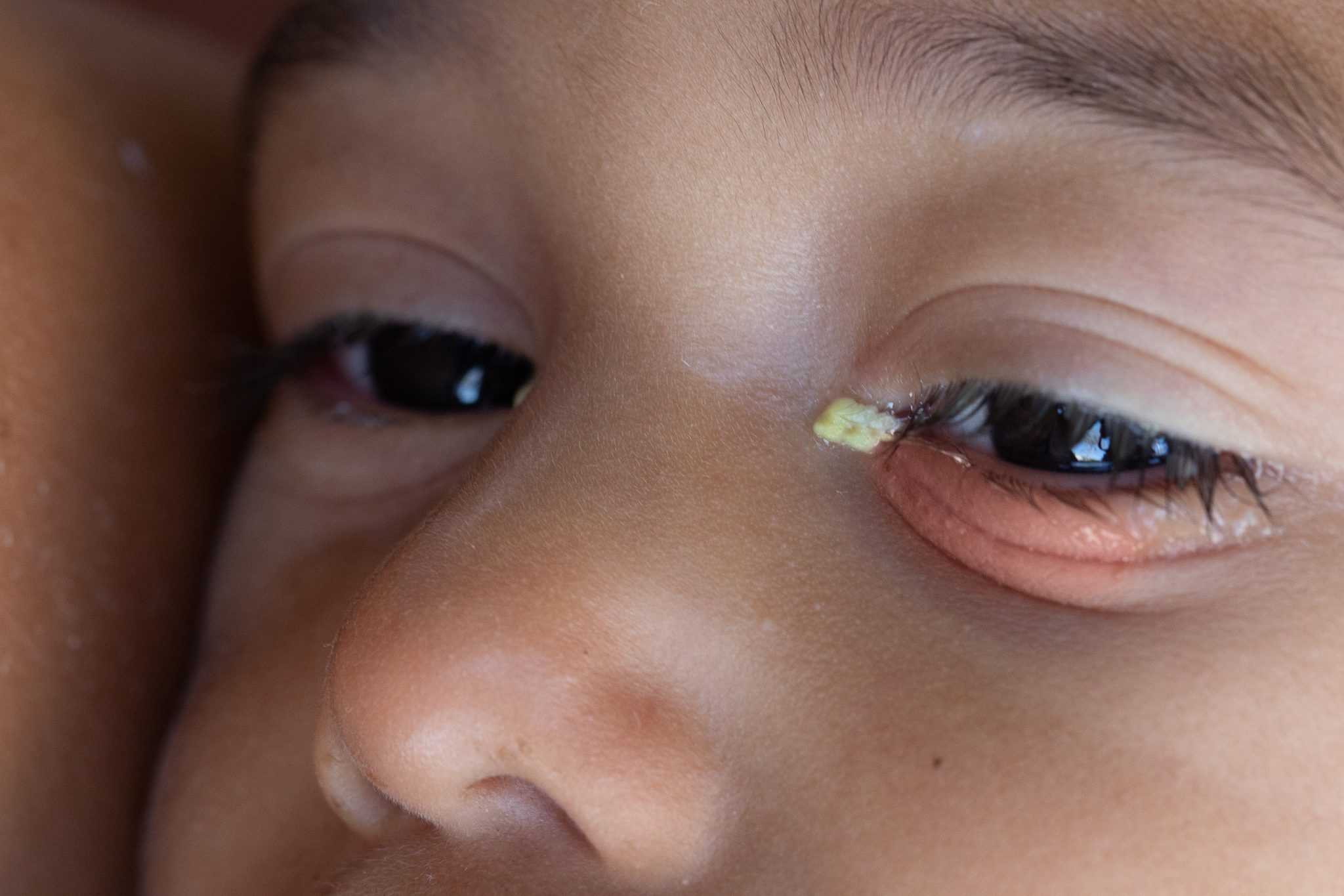 Oftalmóloga Pediatra - Dra. Adriana Valdez